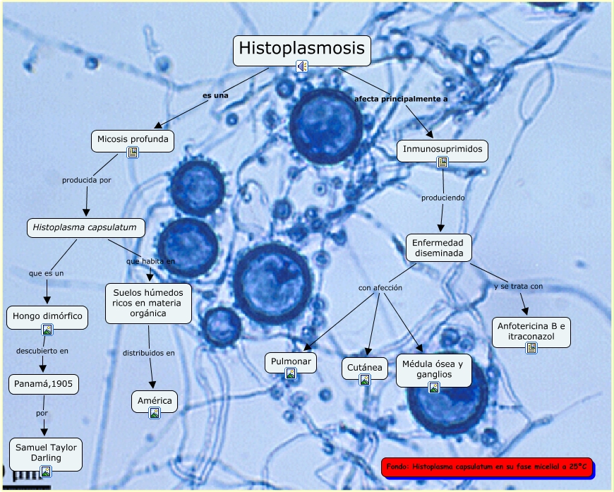 Histoplasmosis - ¿Qué es la Histoplasmosis?
