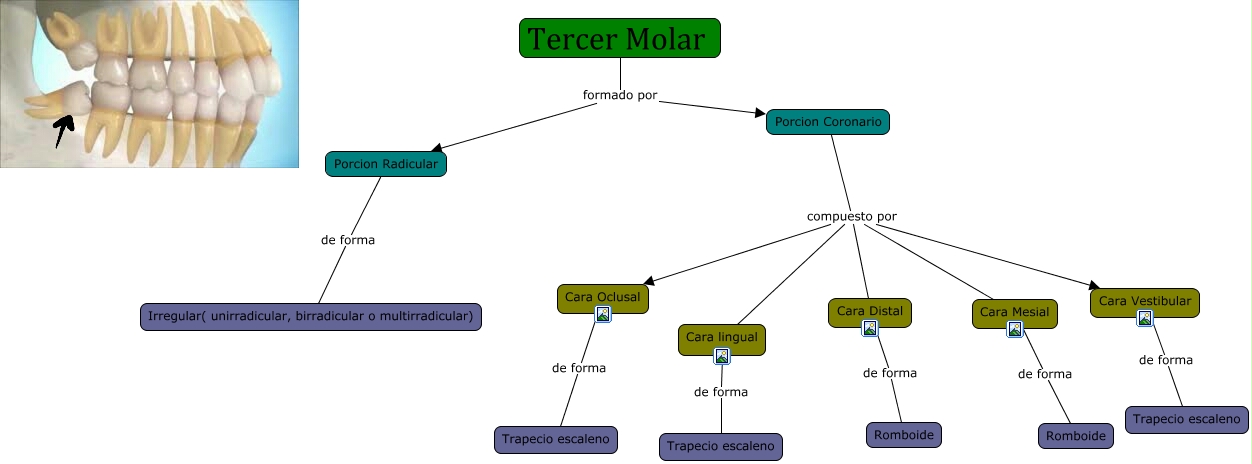 tercer molar inferior